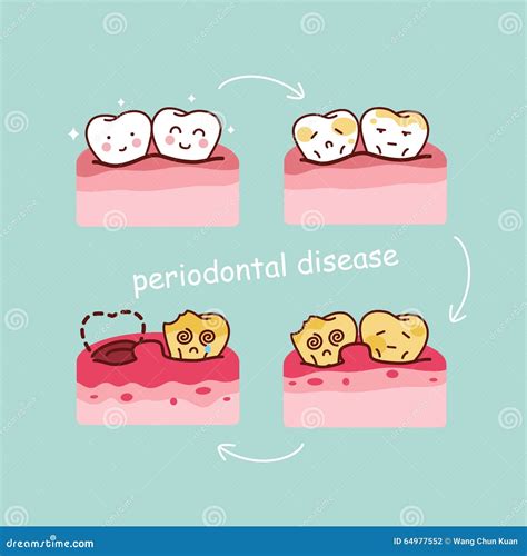 Periodontal Disease Cartoon Vector 70154083