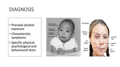 Fetal Alcohol Syndrome Pptpptx