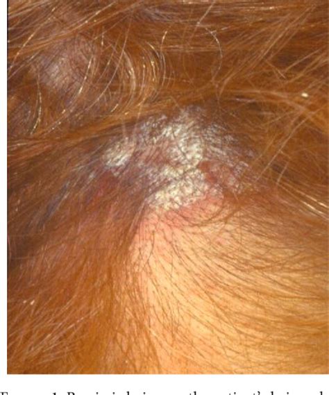 Figure 1 From A Female Psoriatic Arthritis Patient Involving The Tmj