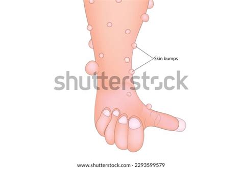 Nf1 Genetic Disorder Over 4 Royalty Free Licensable Stock