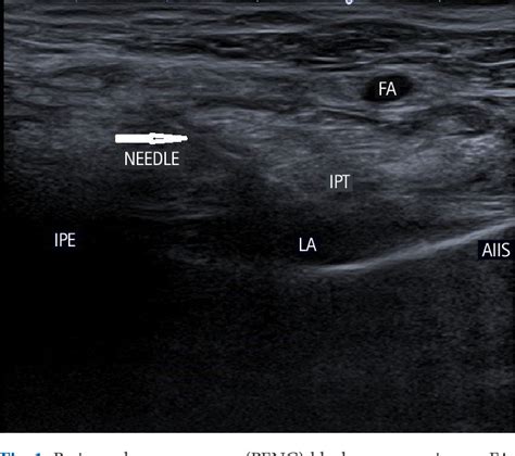 [pdf] Ultrasound Guided Radiofrequency Denervation And Pericapsular Nerve Group Block For