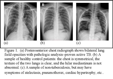 Abnormal Chest X Ray Tuberculosis