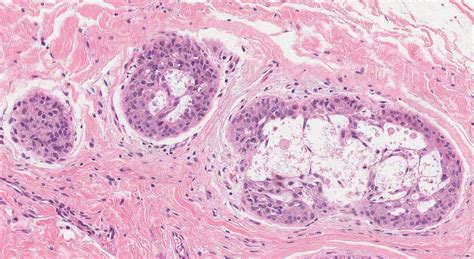 Usual Ductal Hyperplasia Of The Breast Atlas Of Pathology