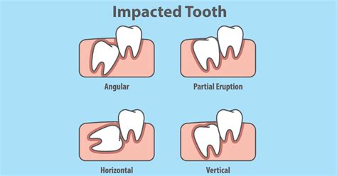 Surgical Removal Of Impacted Teeth 10