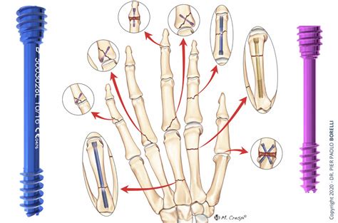Intramedullary Cannulated Headless Screw Fixation For Metacarpal And