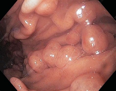 Intestinal Polyps Endoscopy Image Stock Image C048 1970 Science Photo Library