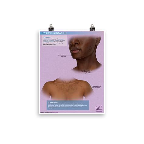 Melalogic Hyperpigmentation Medical Poster — Averygoodidea