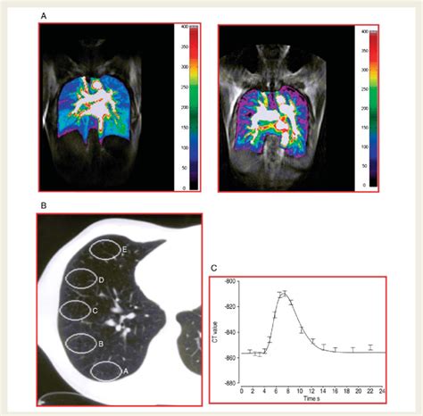 Quantitative Lung Perfusion Analysis With Advanced Magnetic Resonance