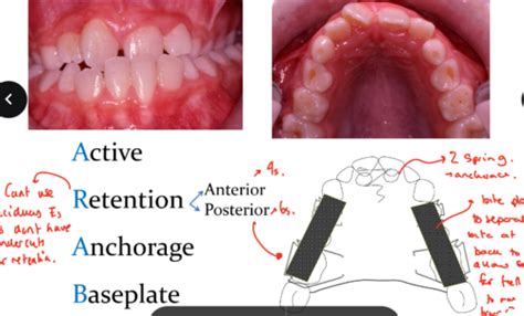 Class Iii Malocclusion Flashcards Quizlet