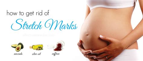 33 Ways How To Get Rid Of Stretch Marks Naturally And Fast