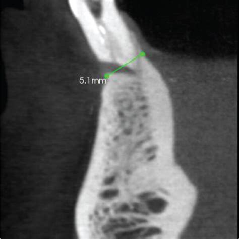 A B Cone Beam Computed Tomography Cbct In Sagittal Section With