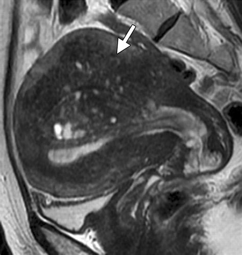 Adenomyosis Usual And Unusual Imaging Manifestations Pitfalls And