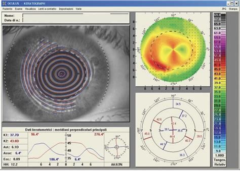 Crstoday Managing Residual Astigmatism After Corneal Ablation