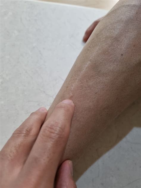 정강이뼈 위에 돌아다니는 혹돌기가 생겼어요 지식in