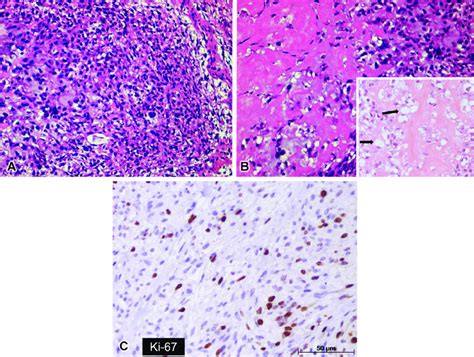 Histopathologic Examination Demonstrated Round To Spindle Shaped Cells