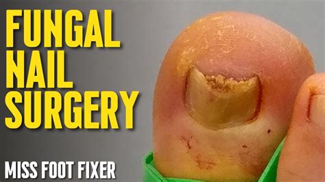 Fungal Nail Surgery Full Treatment Fungal Toenail Removal Full