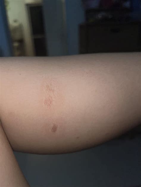Is My Ringworm Healed It Has Already Flattened And Now It Has A Reddish Halo Like Color Around