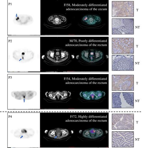 Spect Ct Left And Immunohistochemistry Staining Right Of