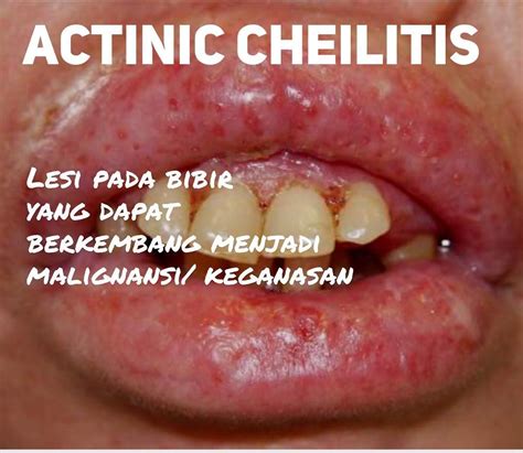 Actinic Cheilitis Actinic Cheilitis Ac Dikenal Juga Dengan Istilah Actinic Cheilosis Farmer Actinic Cheilitis Actinic Cheilitis Ac Dikenal Juga Dengan Istilah Actinic Cheilosis Farmer