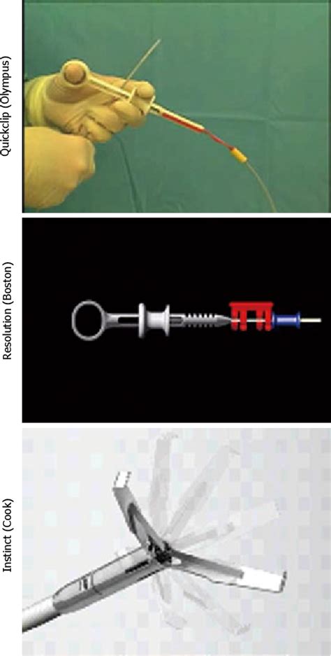 Figure 1 From Endotherapy Of Leaks And Fistula Semantic Scholar