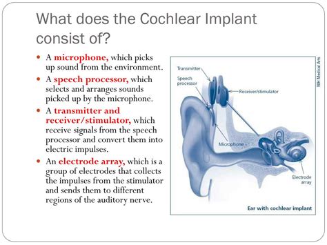 PPT Cochlear Implants PowerPoint Presentation Free Download ID 2753104