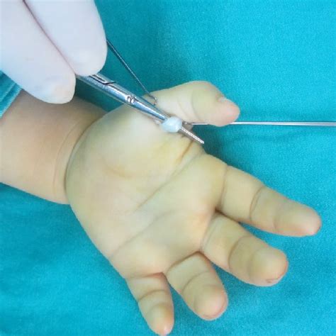 Pdf Trigger Thumb And Finger In Pediatric Patients