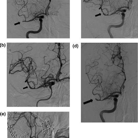A Immediate Postoperative Angiogram Showing Right Inferior M2 Mca Download Scientific Diagram