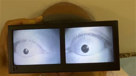 Left Posterior Semicircular Cupulolithiasis Youtube