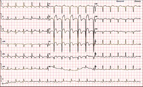 ECG Of Acute Extensive Anterior Myocardial Infarction In A Patient With