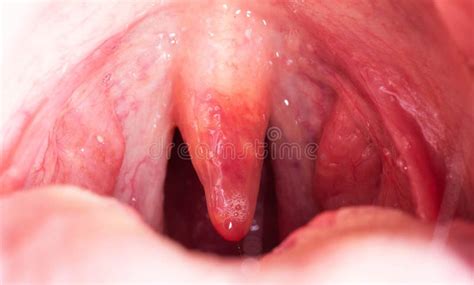 Red Inflamed And Swollen Uvula In The Throat Treatment Of Uvulitis