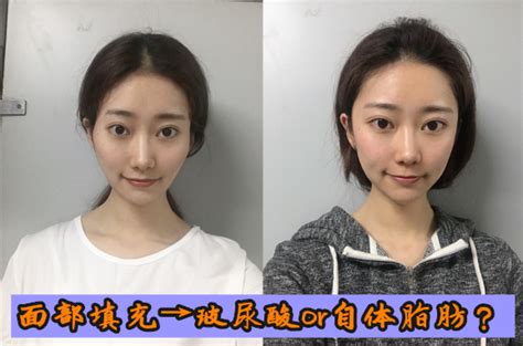 面部填充选玻尿酸还是自体脂肪？ 知乎