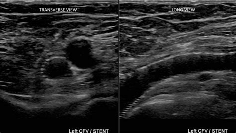 Iliac Vein Stent Ultrasound Angiologist
