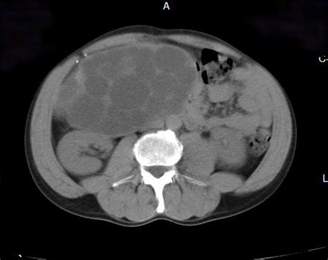 Hydatid Disease Radiology Reference Article