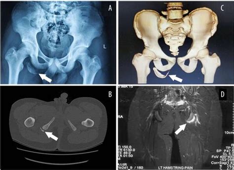 Ischial Tuberosity Avulsion Fracture Wikism Sports Medicine Wiki