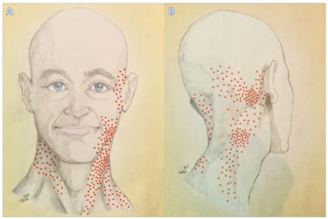 NMT 4 Pain Patterns Flashcards Quizlet