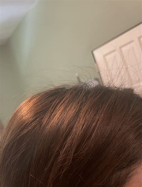 Inositol Rfemalehairloss