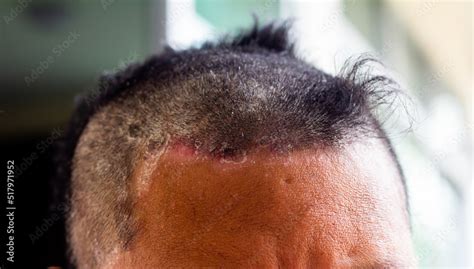 Skin Disease At The Head Dandruff Is A Common Condition That Causes