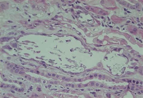 Mowry Stain Original Magnification 400Â Acute Phosphate Nephropathy Download Scientific