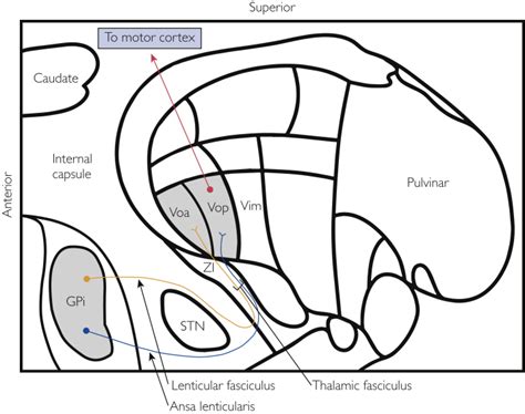 Effectiveness Of Thalamic Ventralis Oralis Anterior And Posterior
