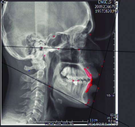 Semi Automated Cephalometric Tracing Using Facad Software Download Scientific Diagram