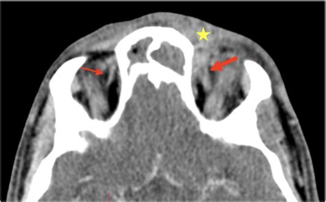 Postseptal Cellulitis Clinico Radiological Quiz Page 4