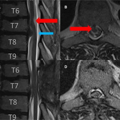 Preoperative Sagittal And Axial Ct Scan In A Soft Tissue Window A And