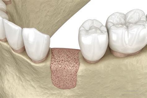 When Do You Need Ridge Augmentation