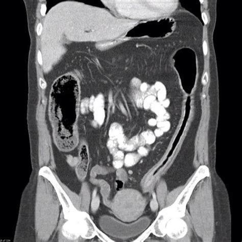 Lead Pipe Sign Narrowed ‘featureless Descending Radiopaedia
