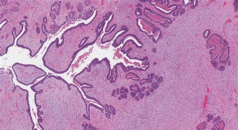 乳腺交界性叶状肿瘤 MyPathologyReport