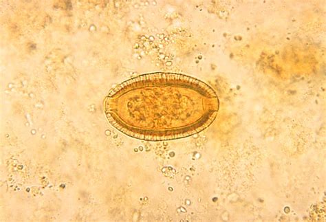 Parasite Of The Day May 3 Capillaria Hepatica