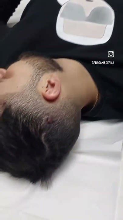 Αφαιρεση σπίλου ελιάς στο τριχωτό της κεφαλής με λειζερ διοξειδίου του