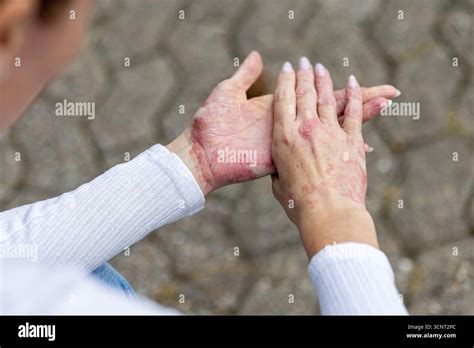 A Person Sits Outdoors Examining Their Hands Affected By Eczema And