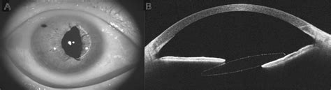 Risk Factors For Pupillary Optic Capture Following Sutureles Retina