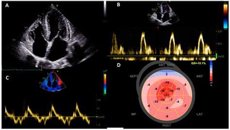 Multimodality Imaging In Cardiomyopathies With Hypertrophic Phenotypes